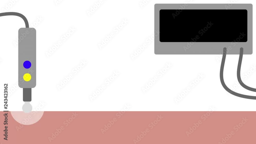 Electrosurgery Monopolar Coagulation Animation with American Labeling ...