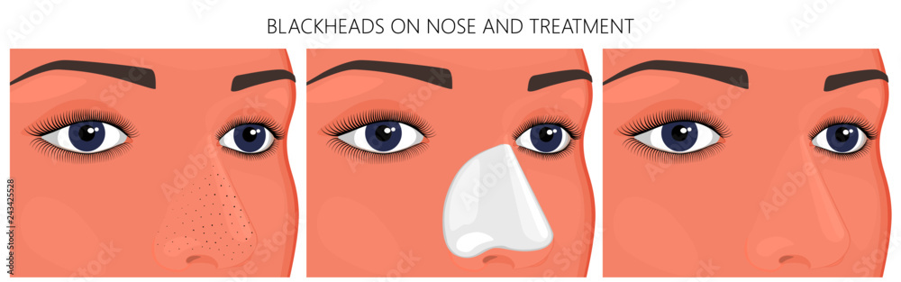 Vector illustration/ Blackheads on face problem (cheeks, nose) before ...