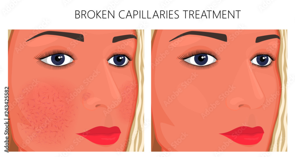 Vector illustration. Broken capillaries on face skin (cheeks, nose ...