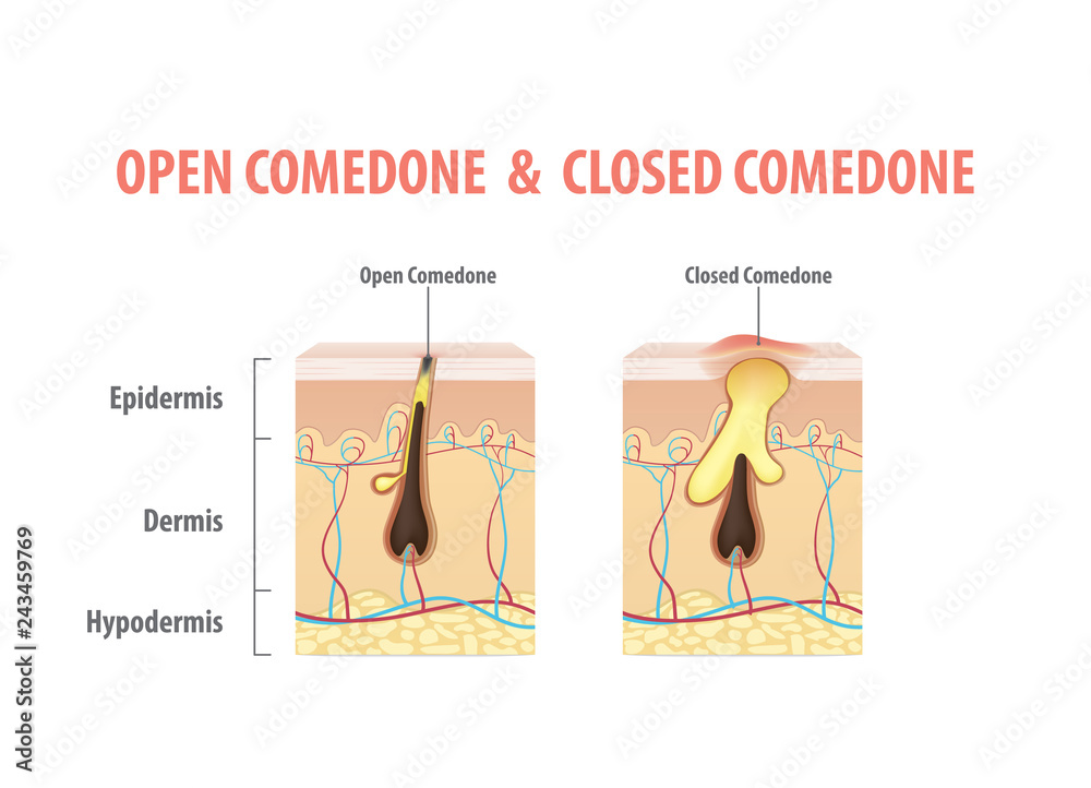 Skin acne comparing with Open Comedone & Closed Comedone condition ...