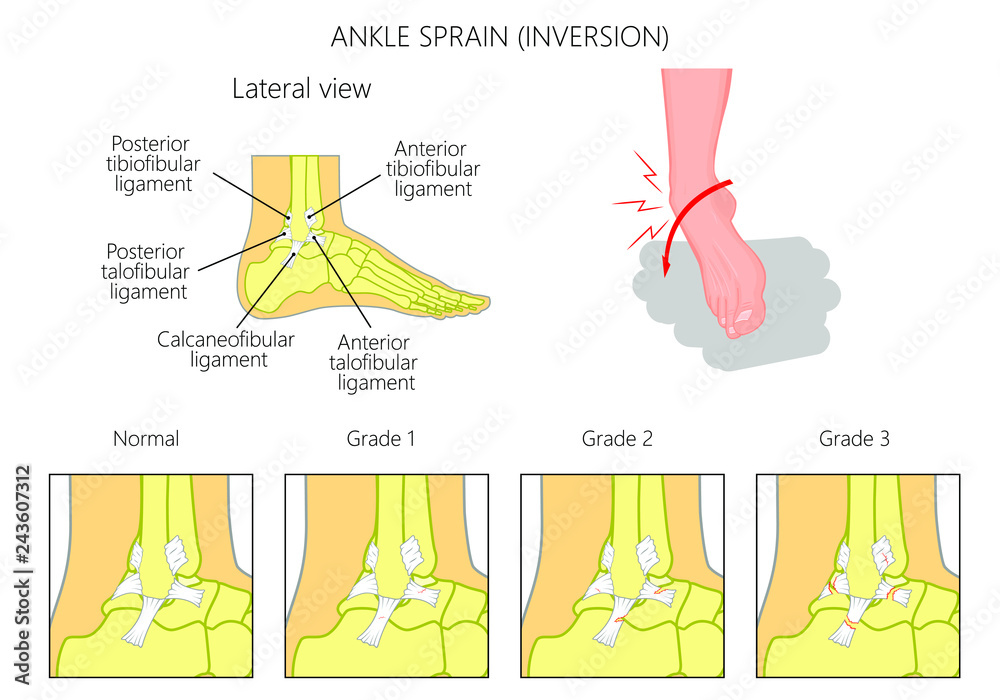 Fototapeta Mechanism of formation of an ankle sprain and Grades of an ...
