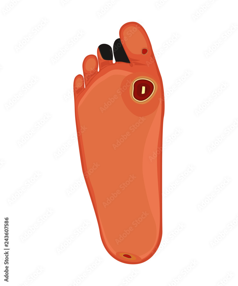 Neuropathic Ulcer
