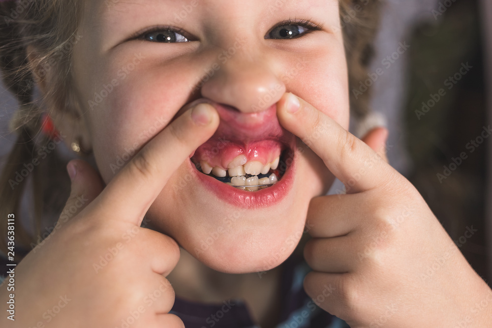 Adult permanent teeth coming in front of the child's baby teeth: shark ...