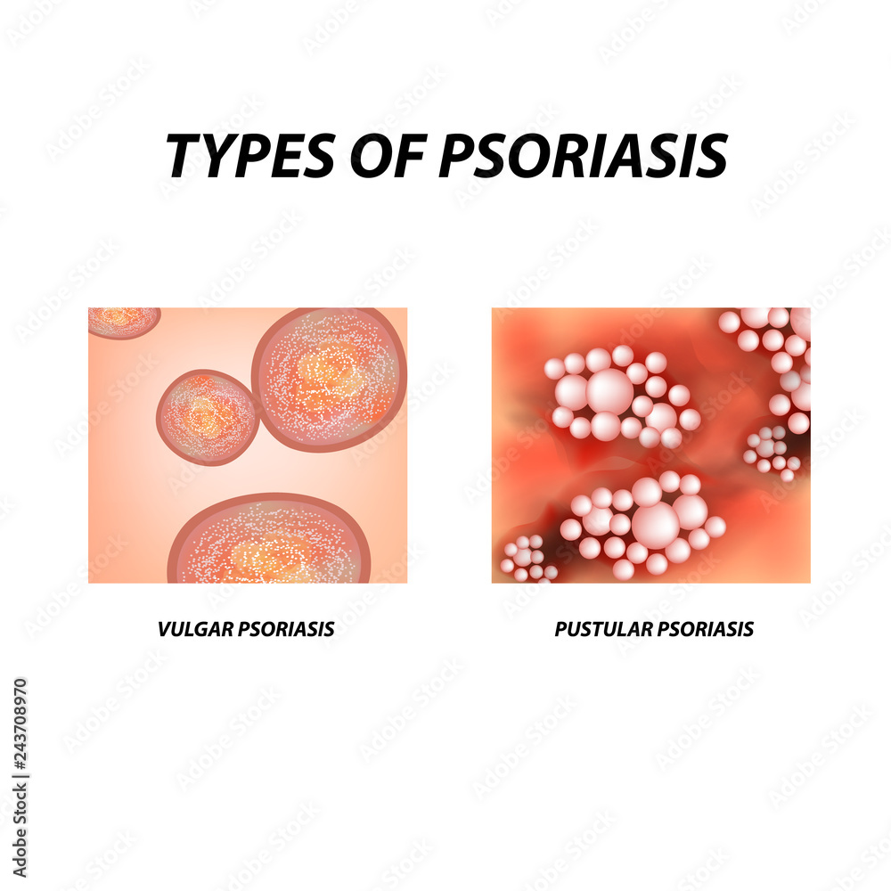 Types of psoriasis. Not pustular and pustular psoriasis. Eczema, skin ...