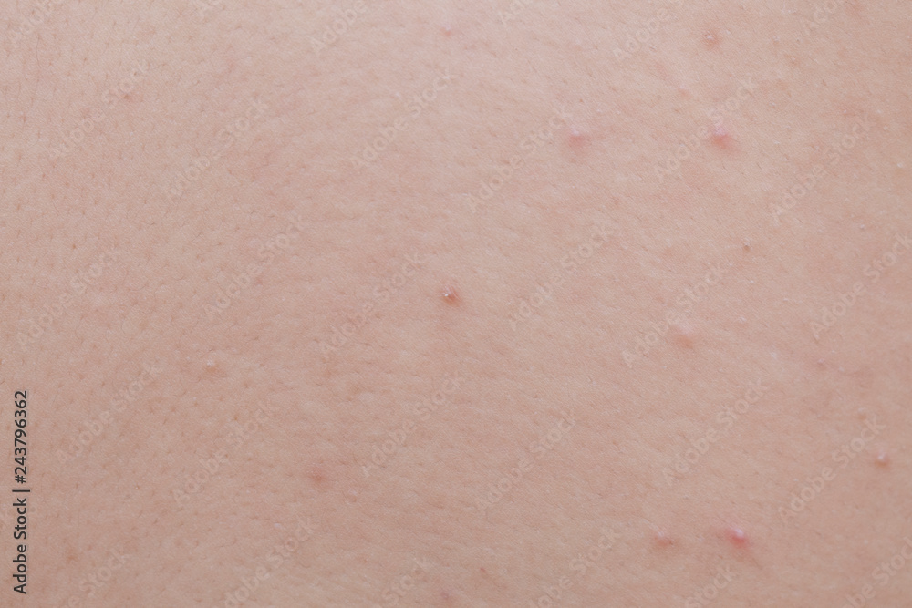 Acne on the skin of people From clogging of the pores. Stock Photo ...