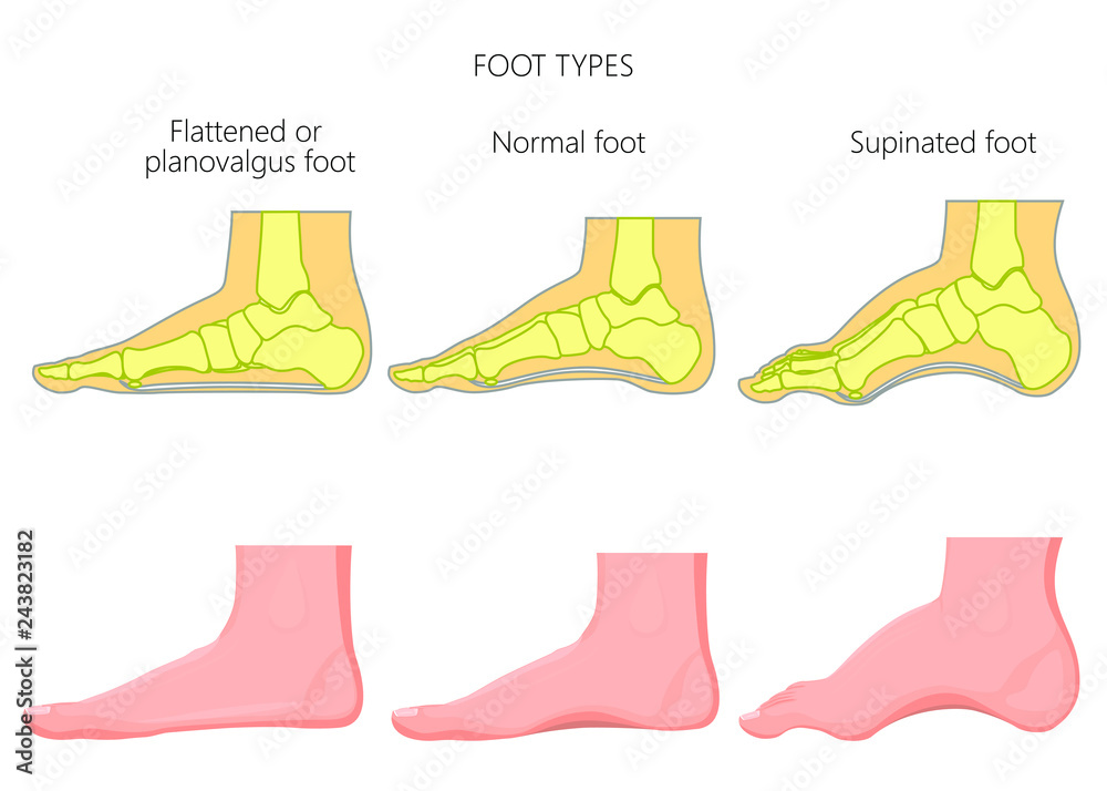 Foot types. External and skeletal views. Stock Vector | Adobe Stock