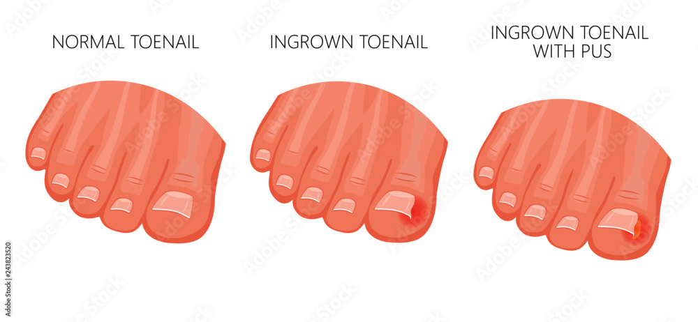 Vector illustration of a healthy foot, foot with ingrown nail ...