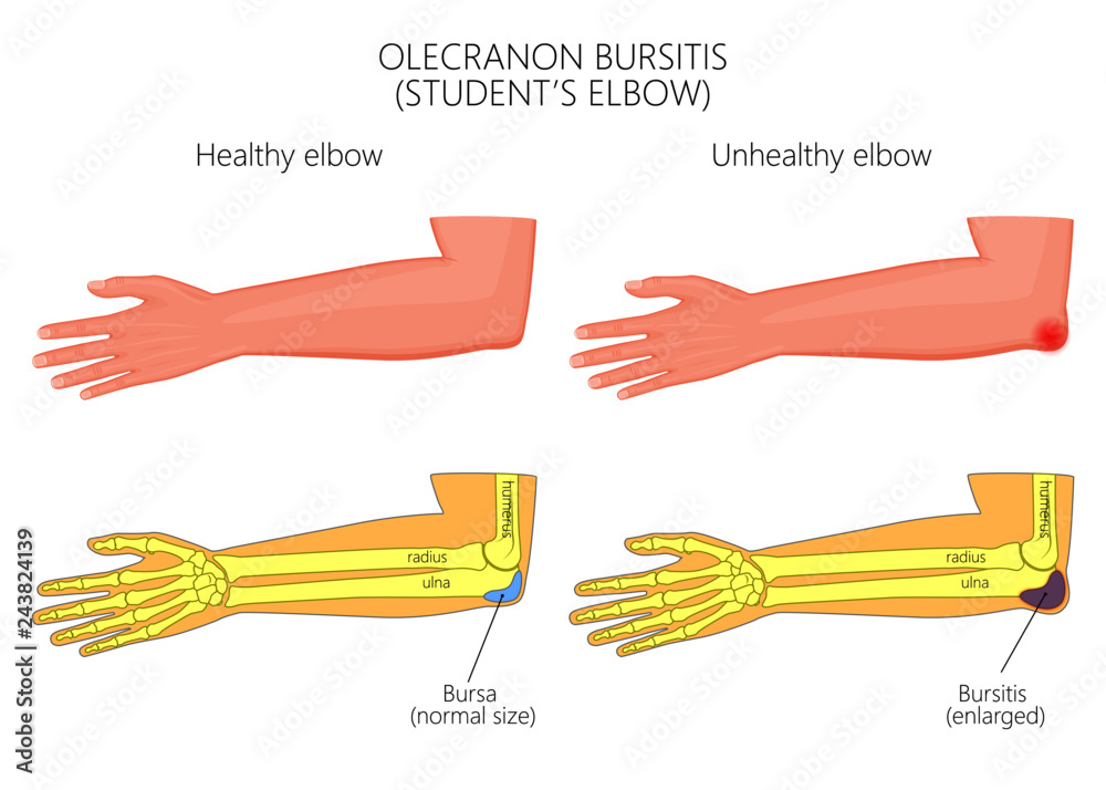 Illustration of Olecranon bursitis or student's elbow. For medical ...
