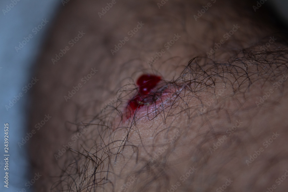 injury - painful knee wound accident. Close up on an bleeding scraped ...