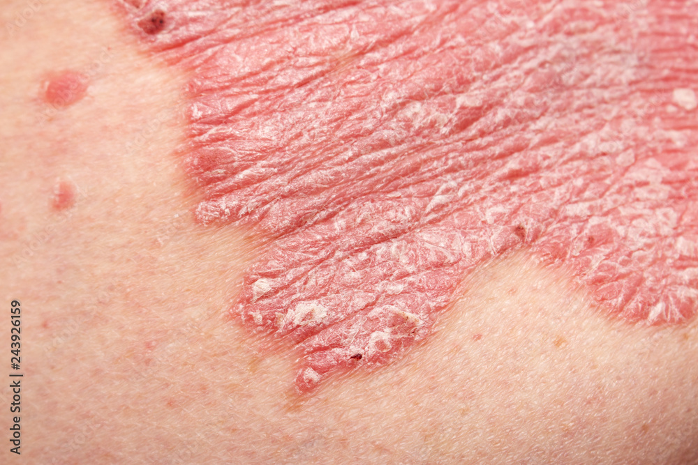 Detail of psoriatic skin disease Psoriasis Vulgaris with narrow focus ...