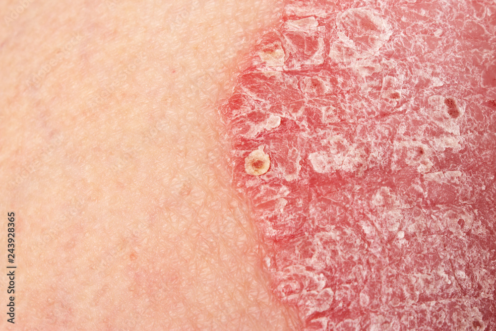 Detail of psoriatic skin disease Psoriasis Vulgaris with narrow focus ...