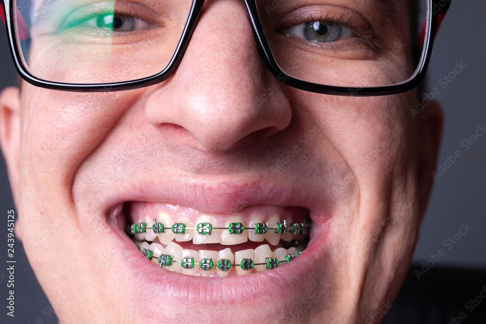 Braces and brackets on teeth, stamotology of medecine alignment of ...