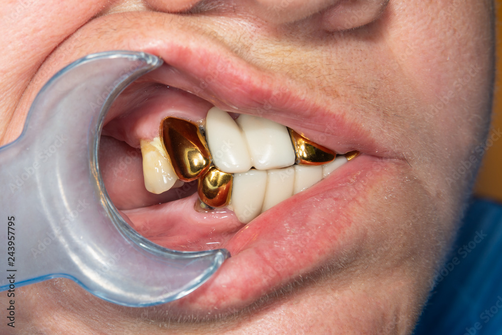 Patient with bad metal dental crowns close-up. The concept of treatment ...