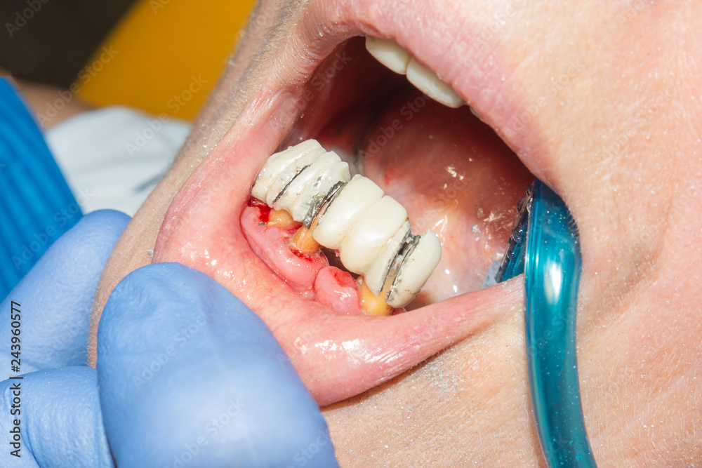 restoration of a rotten tooth decayed tooth close-up. The concept of ...