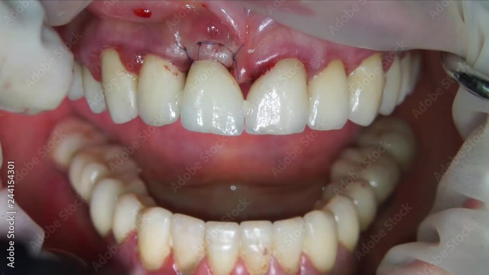 adding a composite material to the crown and adding aesthetic gums ...