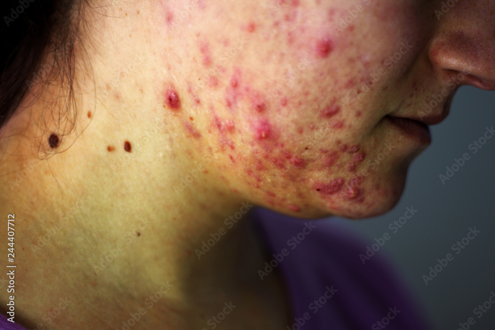 Allergy concept,young girl with problematic pimple on the face.-image ...