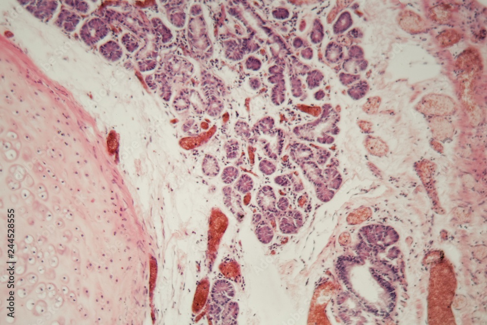 Human lung tissue with Pulmonary embolism under a microscope. Stock ...