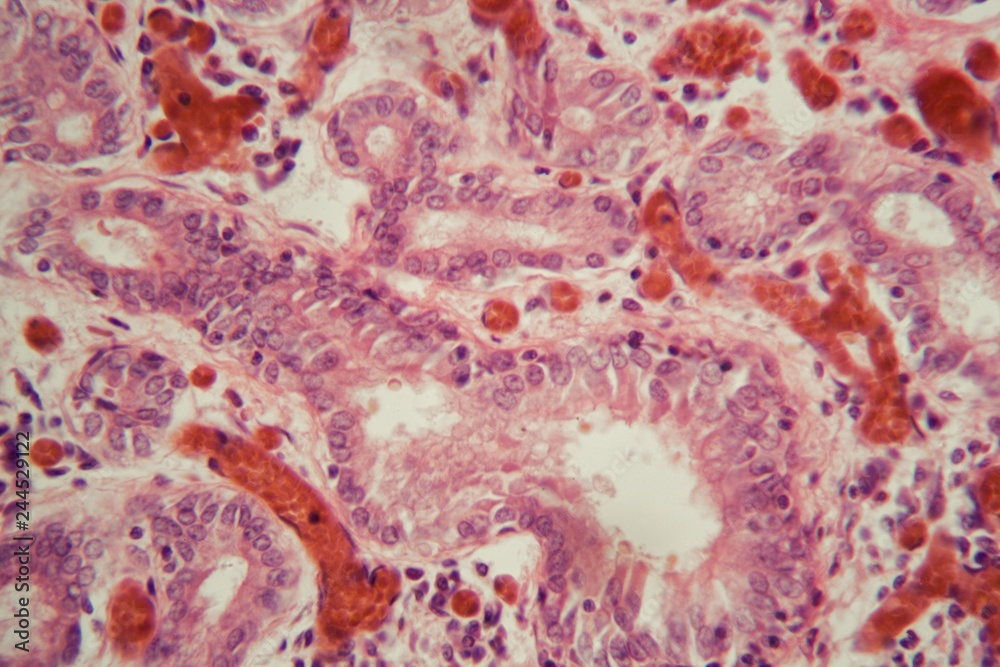 Human lung tissue with Pulmonary embolism under a microscope. Stock ...