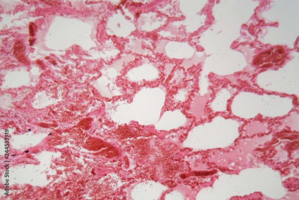 Lung tissue with pneumonia infection caused by flu (Viral pneumonia ...