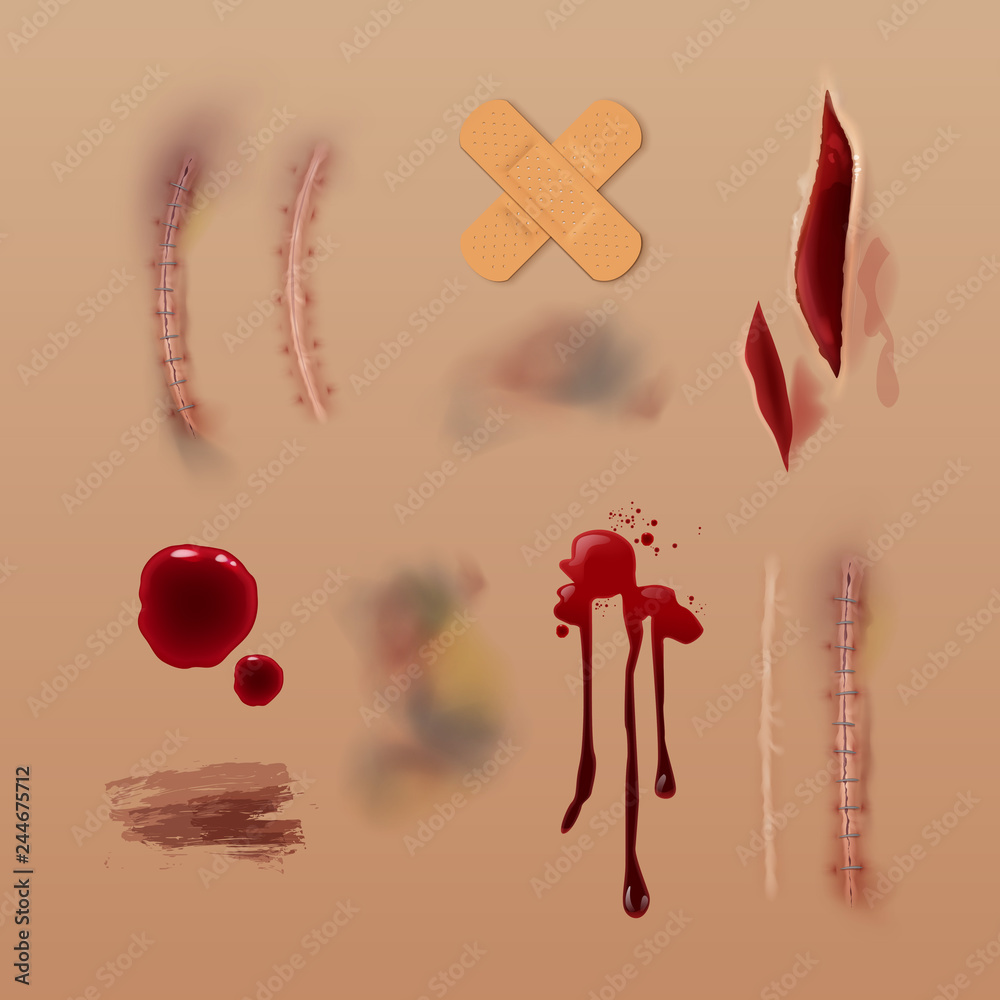 Vector illustration of surgical stitches, scars, bruises, laceration ...
