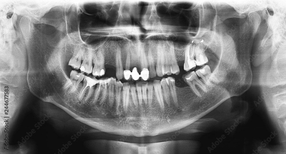 Fototapeta Panoramic radiograph is a panoramic scanning dental X-ray of ...