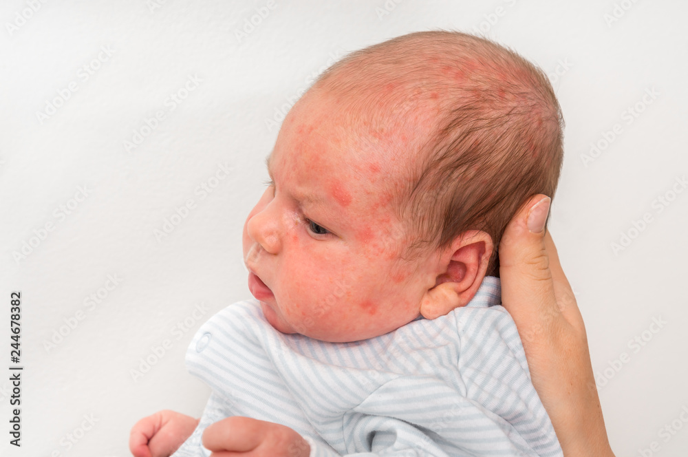 Newborn baby with skin rash. Allergic reaction after birth. Stock Photo ...
