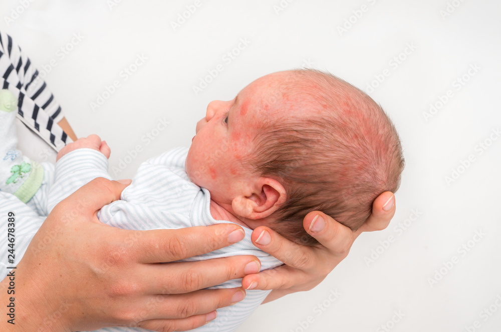 Newborn baby with skin rash. Allergic reaction after birth. Stock Photo ...