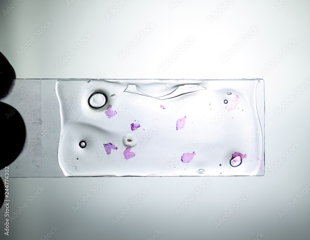 Slices of the tumor under glass. Histological examination of tumor ...