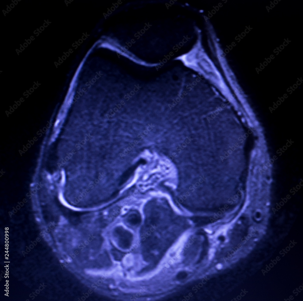 Poster MRI knee meniscus tear scan – Wall Art | UkPosters
