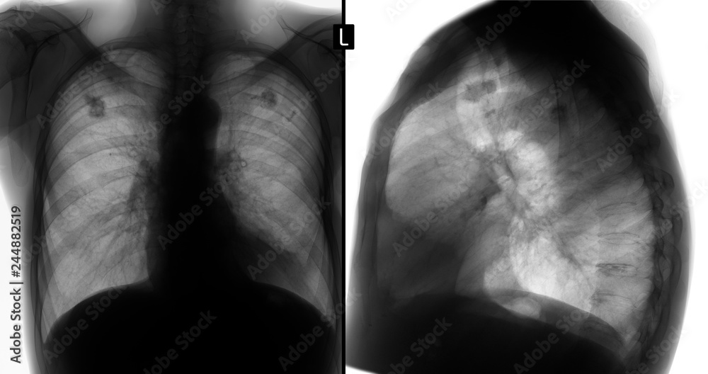 X-ray of the lungs. Post-tuberculosis changes. Calcifications. Negative ...