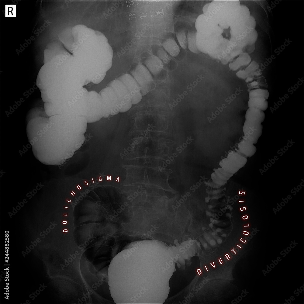 X-ray of the lower parts of the gastrointestinal tract (GI). Tight ...