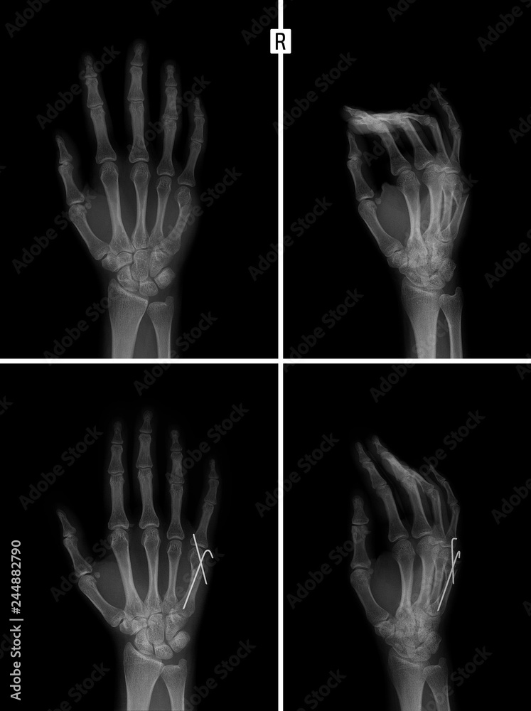 X-ray of the hand. Fracture of the 5rd metacarpal bone. Reposition ...
