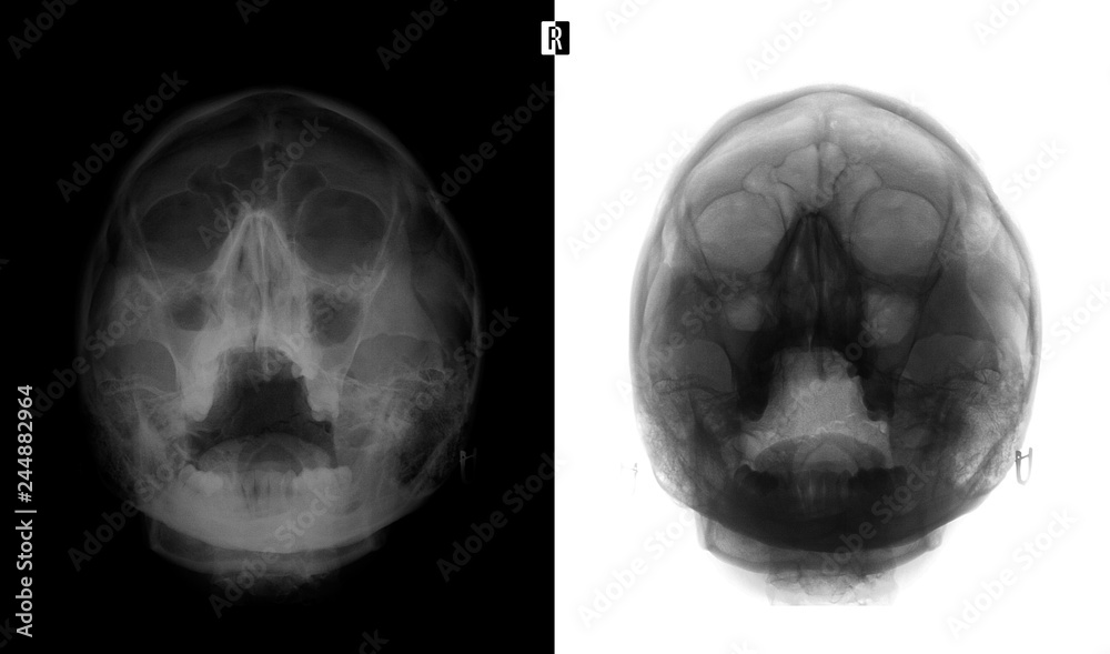 X-ray of the paranasal sinuses. Bilateral maxillary sinusitis. Stock ...