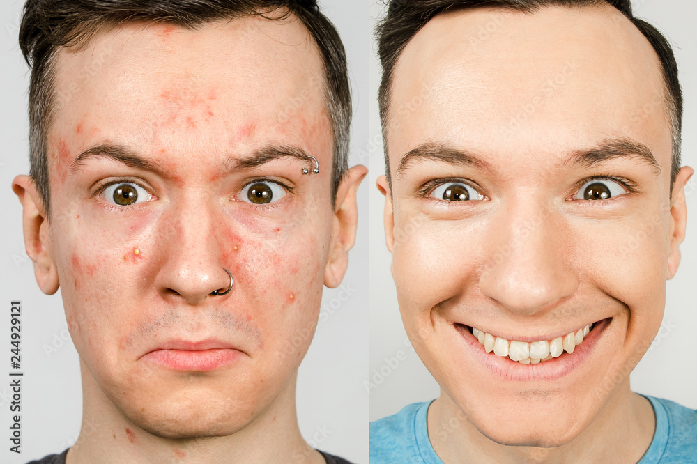 Foto de two guys before-after: left guy with acne, red spots, problem ...