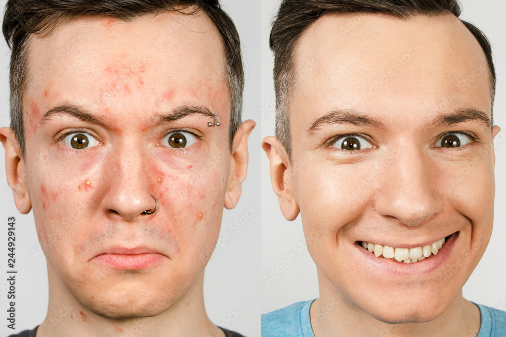 two guys before-after: left guy with acne, red spots, problem skin ...