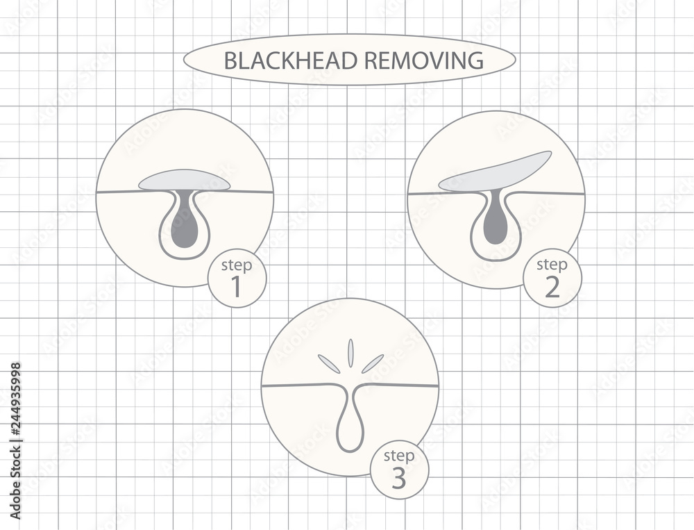 Blackhead Removal Diagram