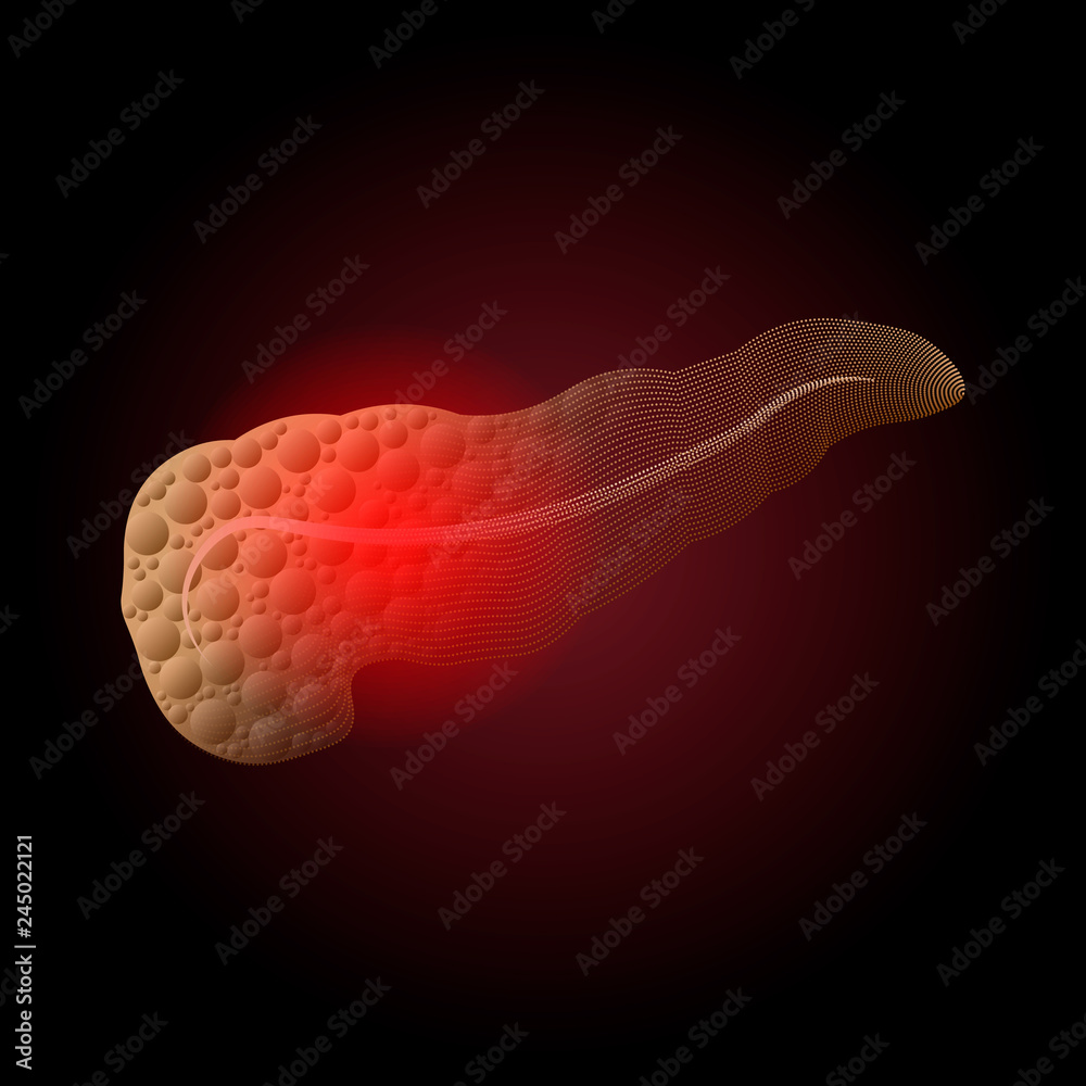 Pancreatitis. Medical illustration of diseases of the pancreas of a ...