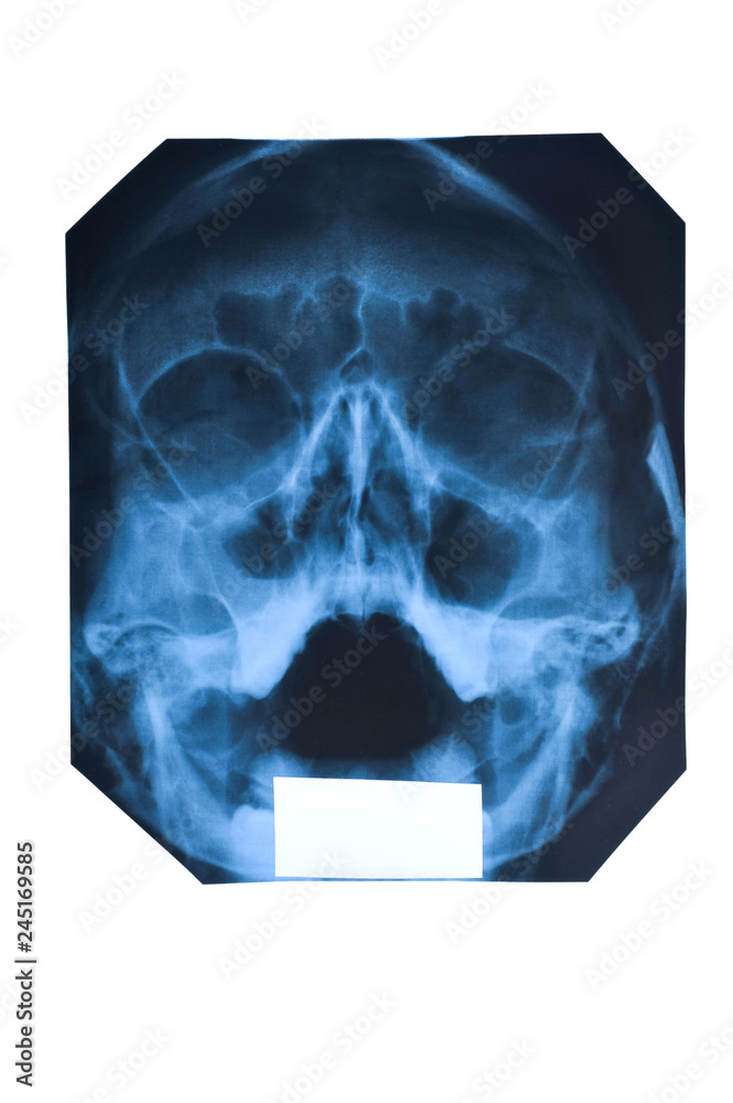 x-ray of face and maxillary sinuses Stock Photo | Adobe Stock