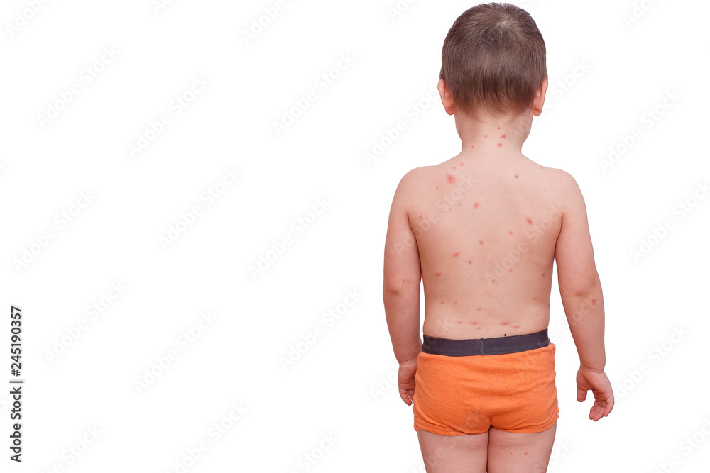 Closeup, full of blisters,scar and rash caused by chickenpox on a white ...