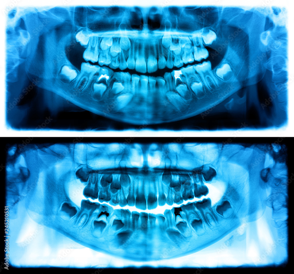 Panoramic radiograph is a scanning dental X-ray of the upper jaw ...