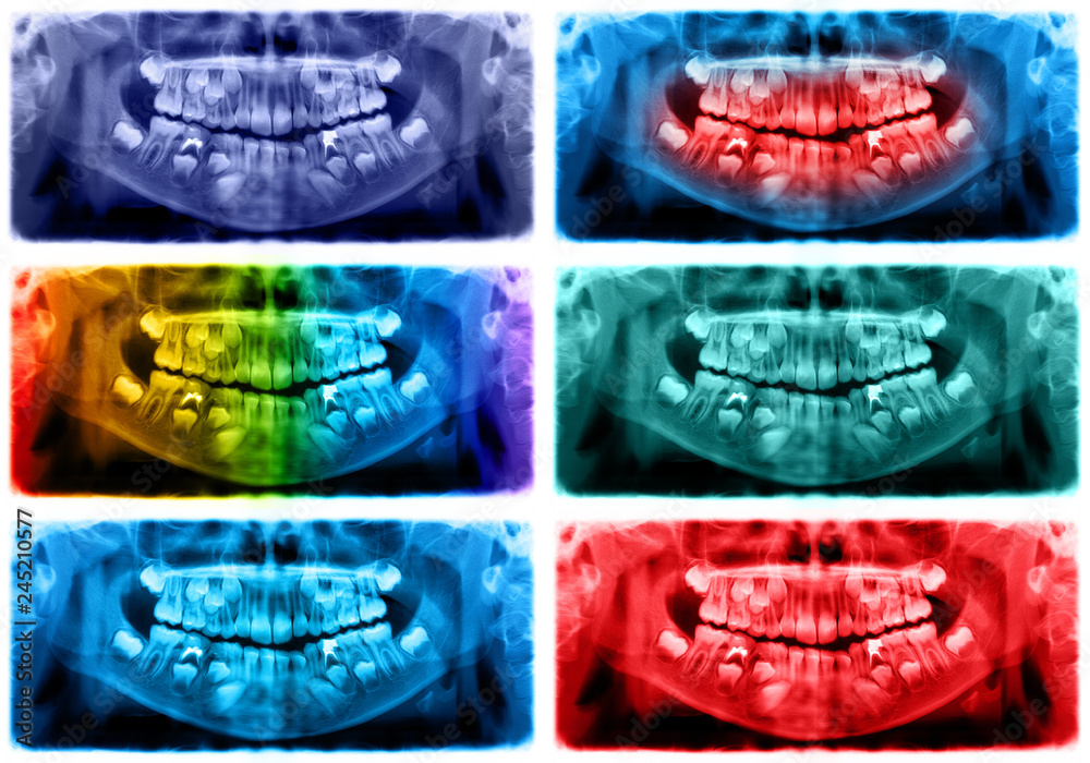 Panoramic radiograph is a scanning dental X-ray of the upper jaw ...