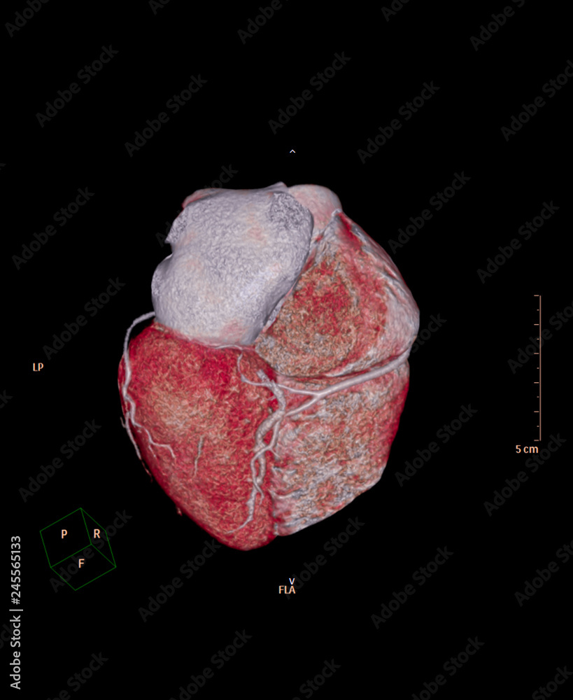 bottom view of CTA Coronary artery 3D rendering image show coronary ...
