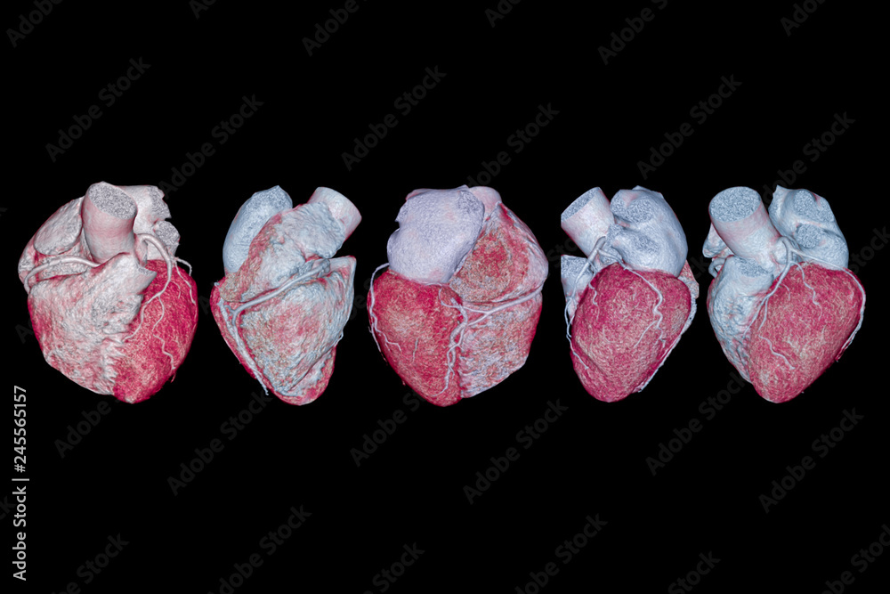 Collection of CTA Coronary artery 3D rendering image show coronary ...