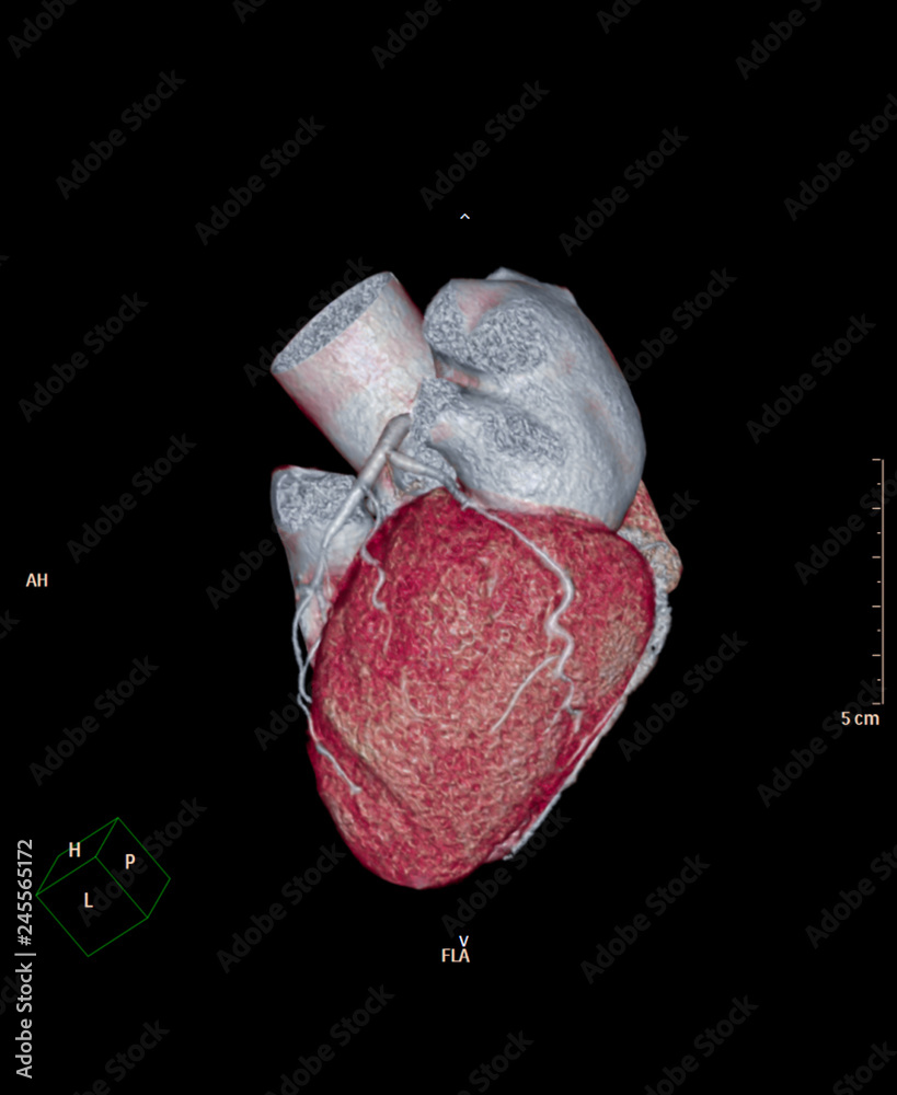 CTA Coronary artery 3D rendering image side view show coronary artery ...