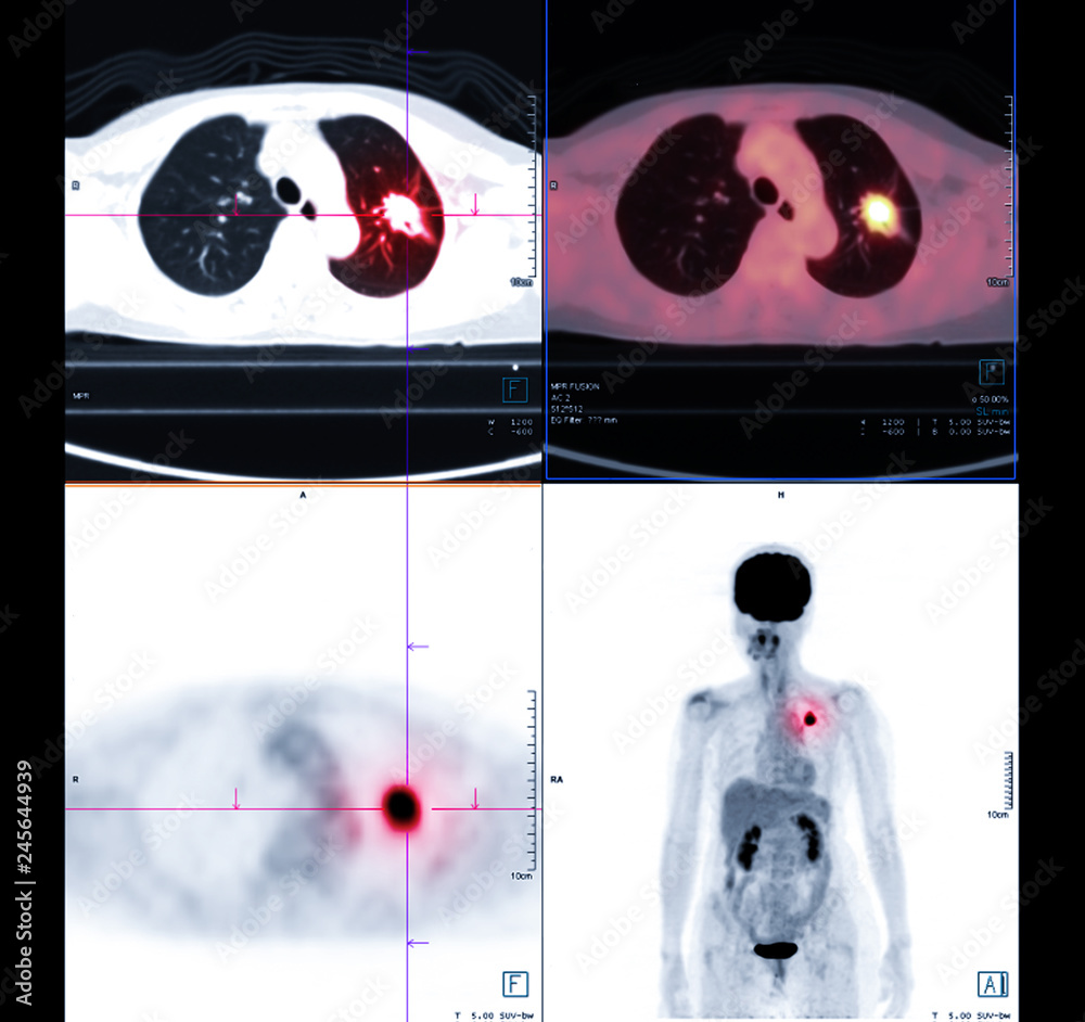 PET Scan image of the Chest Comparison Axial and Coronal plane showign ...