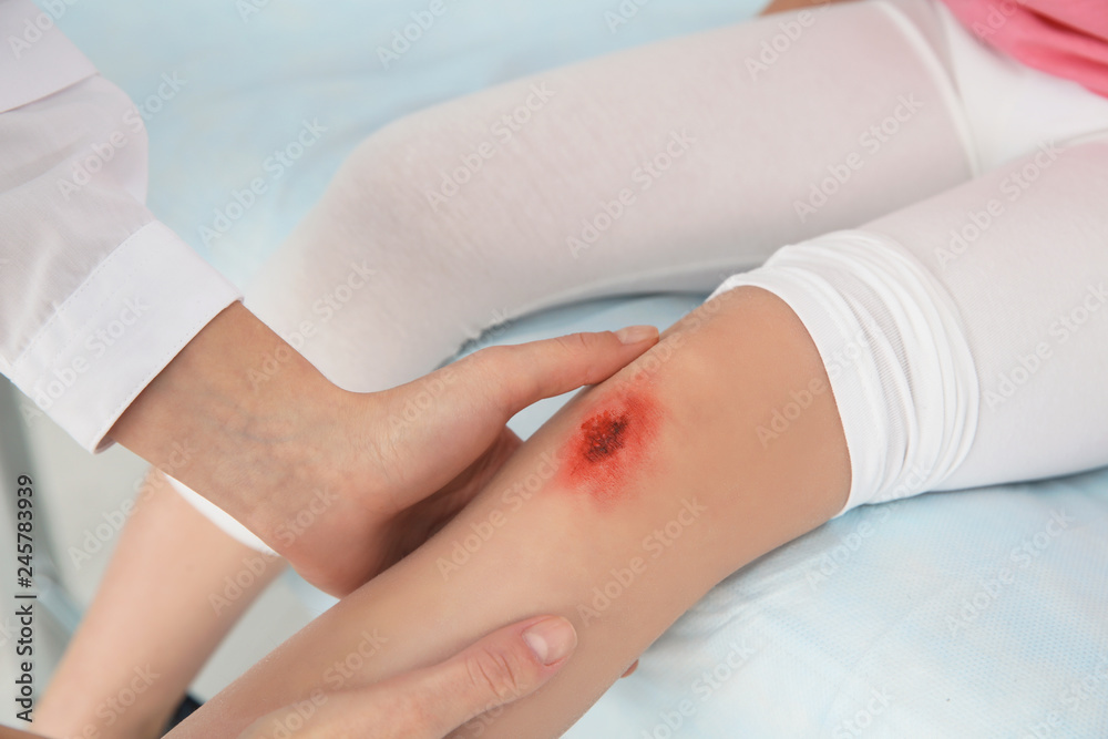 Female doctor examining little girl's injured leg in clinic, closeup ...