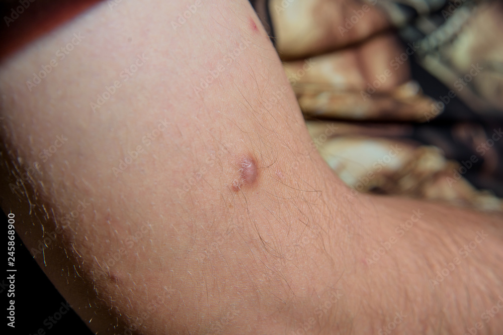 Mosquito bite on hand. Human leg. Skin structure Body hair Damaged skin ...
