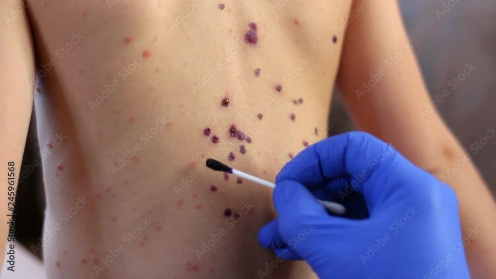 Chickenpox Blisters Lubricated with Antiseptic Drug with Cotton Swab ...