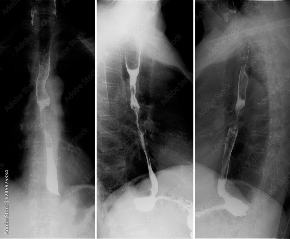 X-ray of the upper gastrointestinal series (UGI) with barium. Cancer of ...