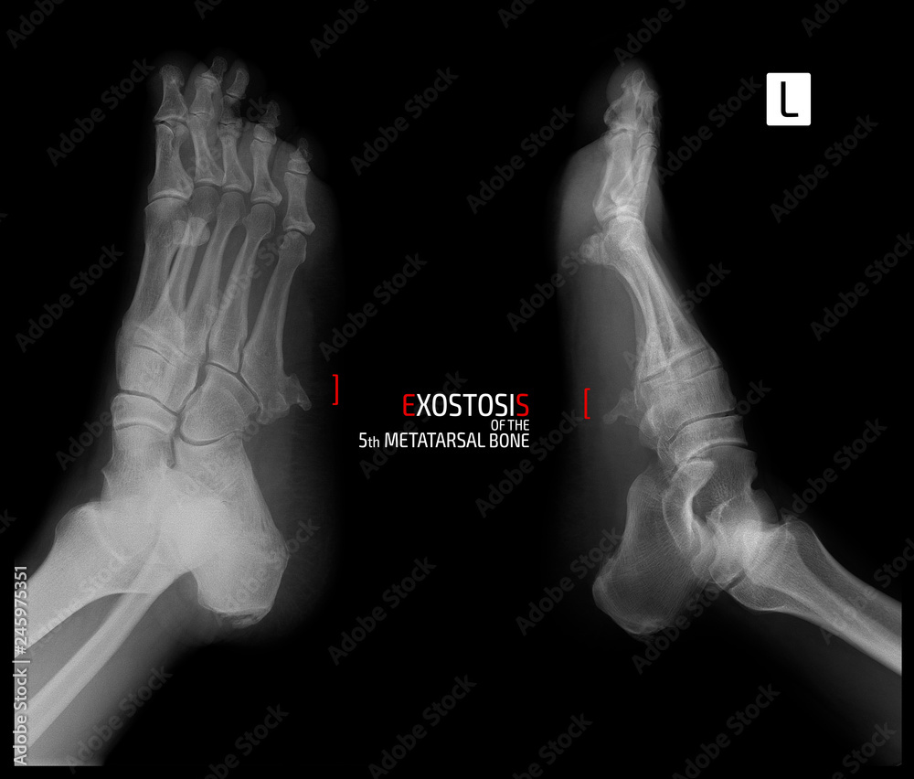 X-ray of the foot. Exostosis of the 5th metatarsal bone. Marker. Stock ...